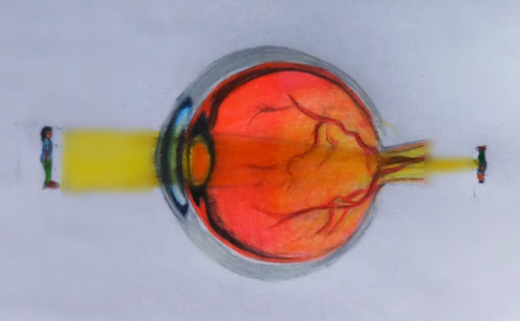 Optics of Hyperopia - Optography