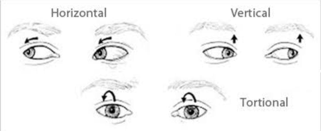 Nystagmus - Optography
