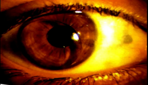 FITTING PROCEDURE FOR RIGID CONTACT LENS - Optography