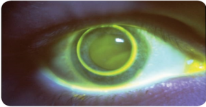 FITTING PROCEDURE FOR RIGID CONTACT LENS - Optography