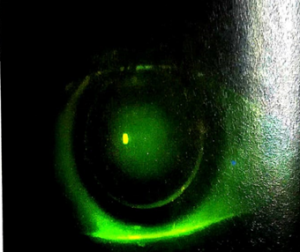 FITTING PROCEDURE FOR RIGID CONTACT LENS - Optography