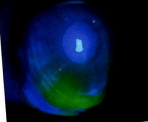FITTING PROCEDURE FOR RIGID CONTACT LENS - Optography
