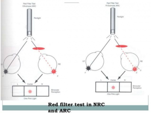ARC (ABNORMAL RETINAL CORRESPONDENCE) - Optography