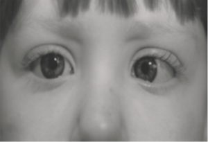 CLINICAL TYPES OF OCULAR DEVIATION - Optography
