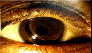 FITTING PROCEDURE FOR RIGID CONTACT LENS - Optography