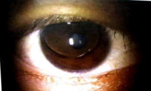 FITTING PROCEDURE FOR RIGID CONTACT LENS - Optography