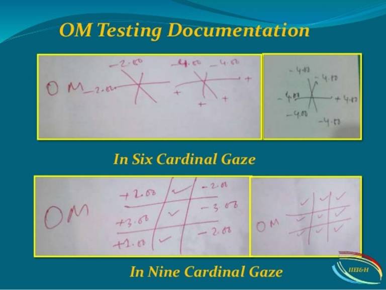 Assessment of Ocular Movements - Optography