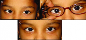 DIVERGENCE INSUFFICIENCY - Optography