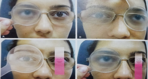 Dissociated vertical and horizontal deviation of vertical strabismus ...