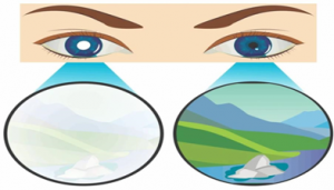 VERTICAL STRABISMUS - Optography