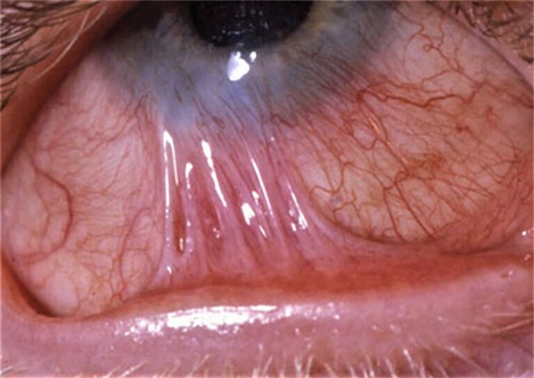 Symblepharon Prognosis - Optography