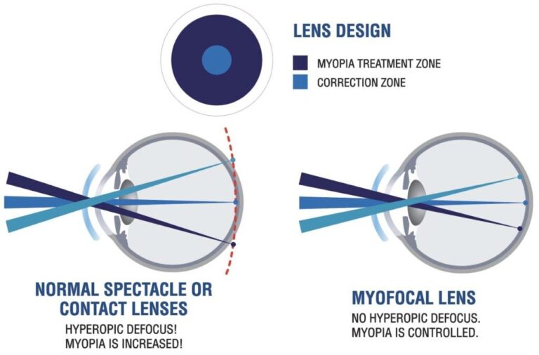 UNDERSTANDING THE ROLE OF CONTACT LENSES IN MYOPIA CONTROL - Optography