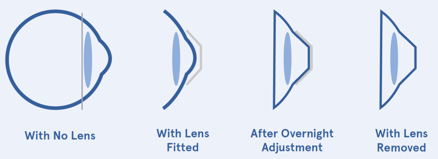 Orthokeratology (Ortho-K Lens) - Optography